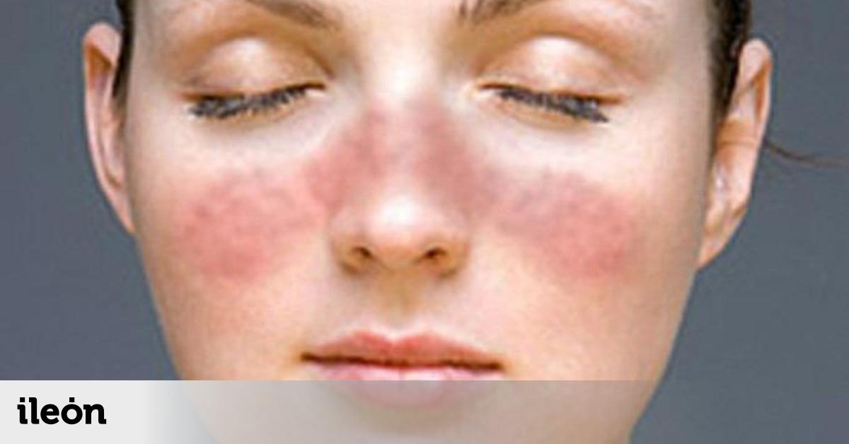 Prueban la eficacia de la terapia CAR-T contra el lupus