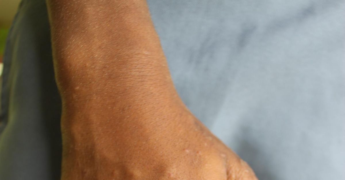 Aumentan los casos de sarna en Castilla-La Mancha pero Sanidad pide no generar "alarma"